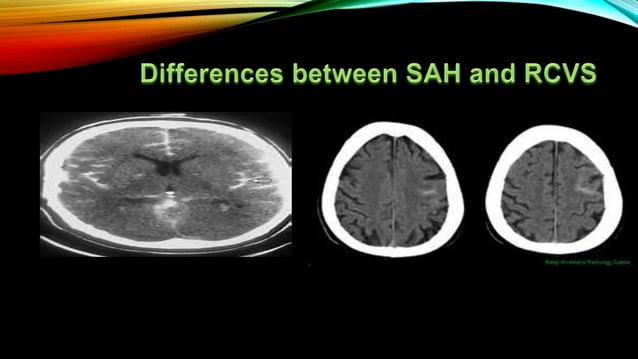 Reversible cerebral vasoconstriction syndrome | PPTX