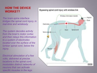 Reversing paralysis | PPTX