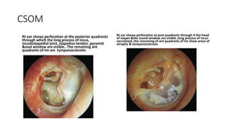 revesion of external and middle ear pathologies.pptx