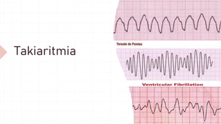 Review ACLS Bismillah.pdf
