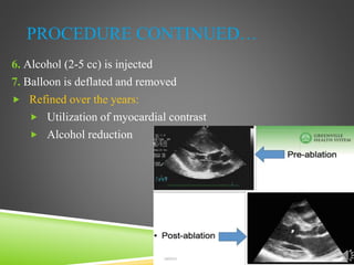 Septal Ablations Presentation | PPTX