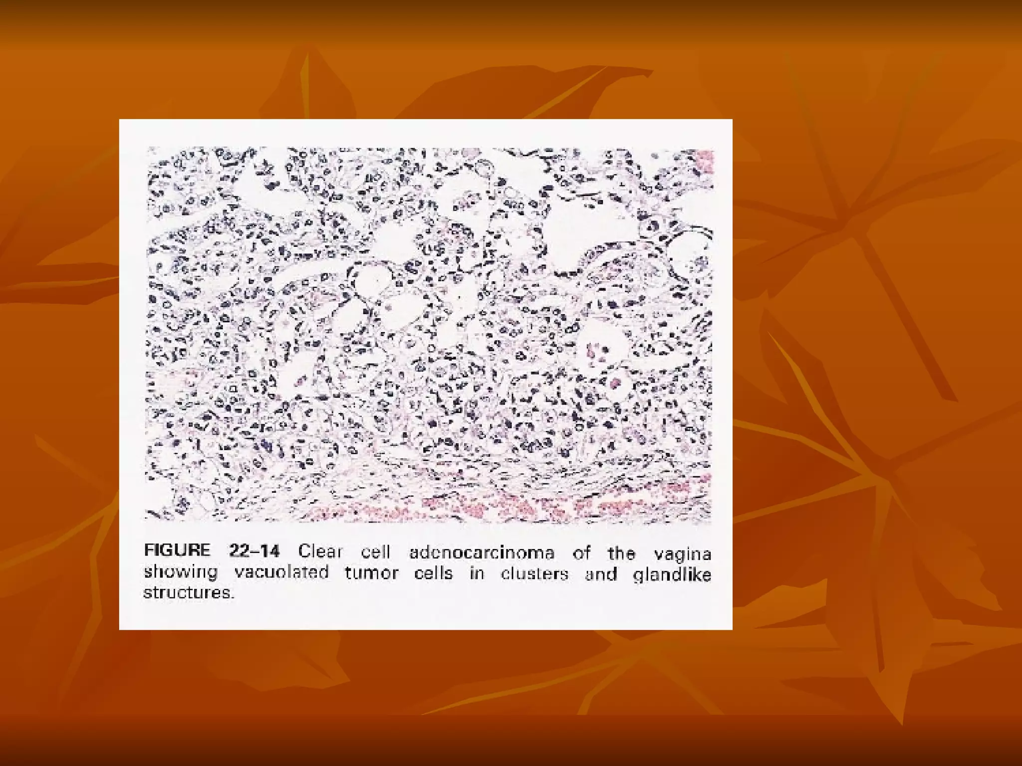 Female Genital Tract Pathology | PPT