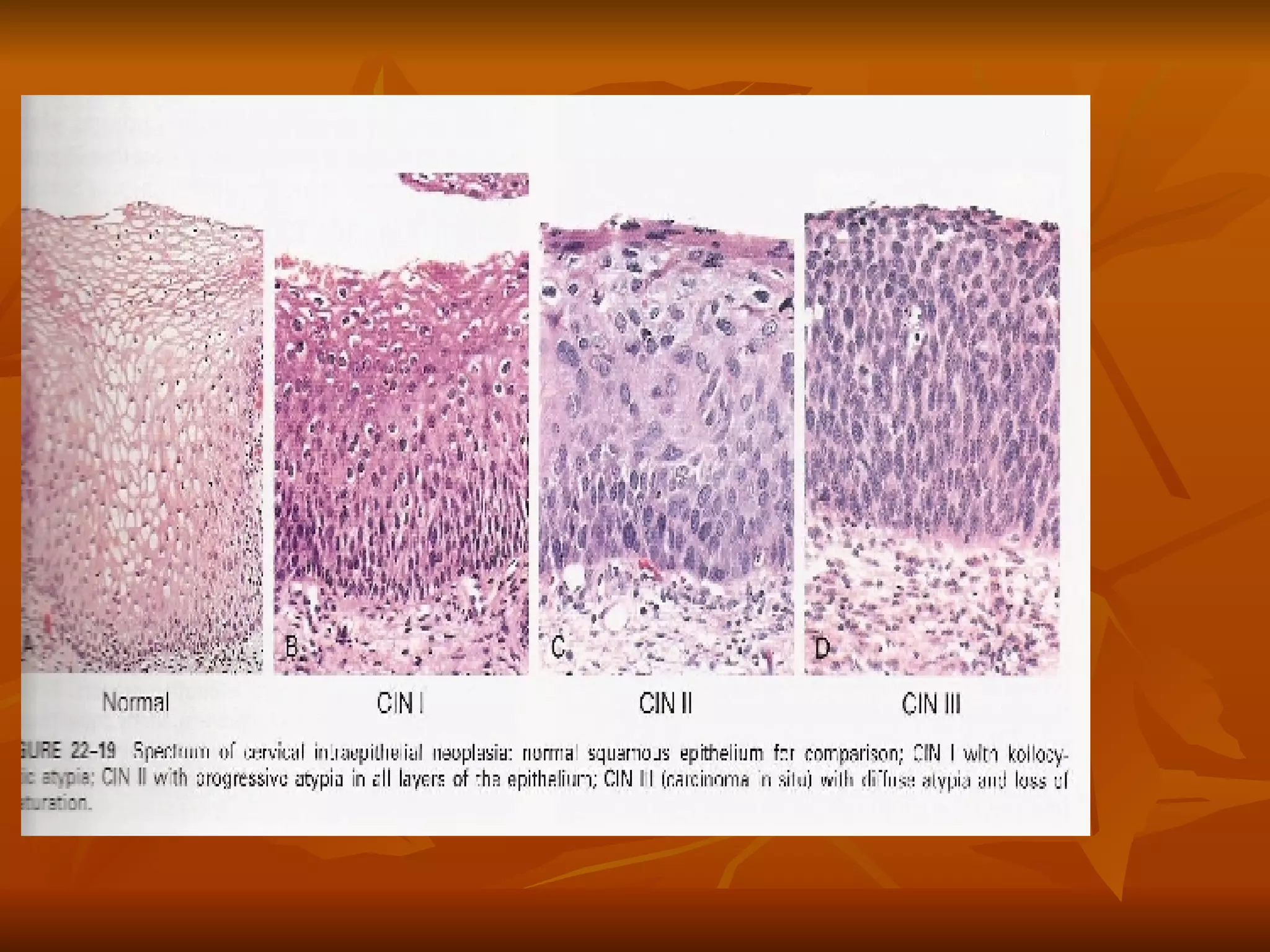 Female Genital Tract Pathology | PPT