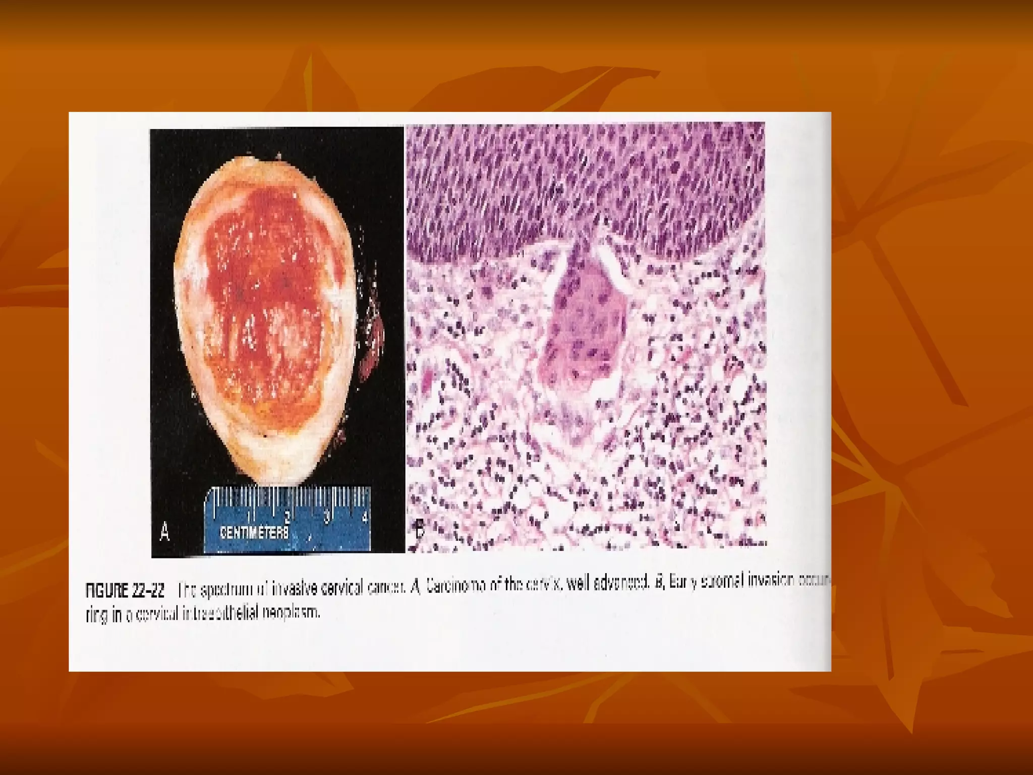 Female Genital Tract Pathology | PPT
