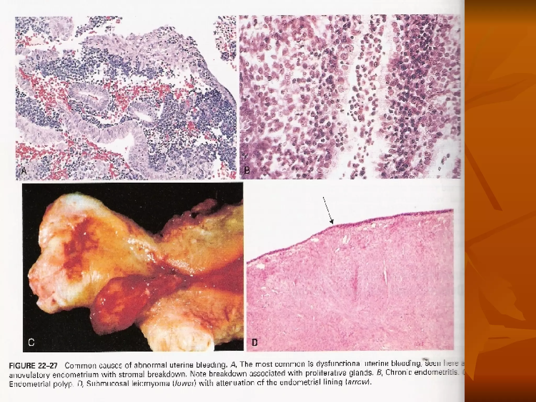 Female Genital Tract Pathology | PPT