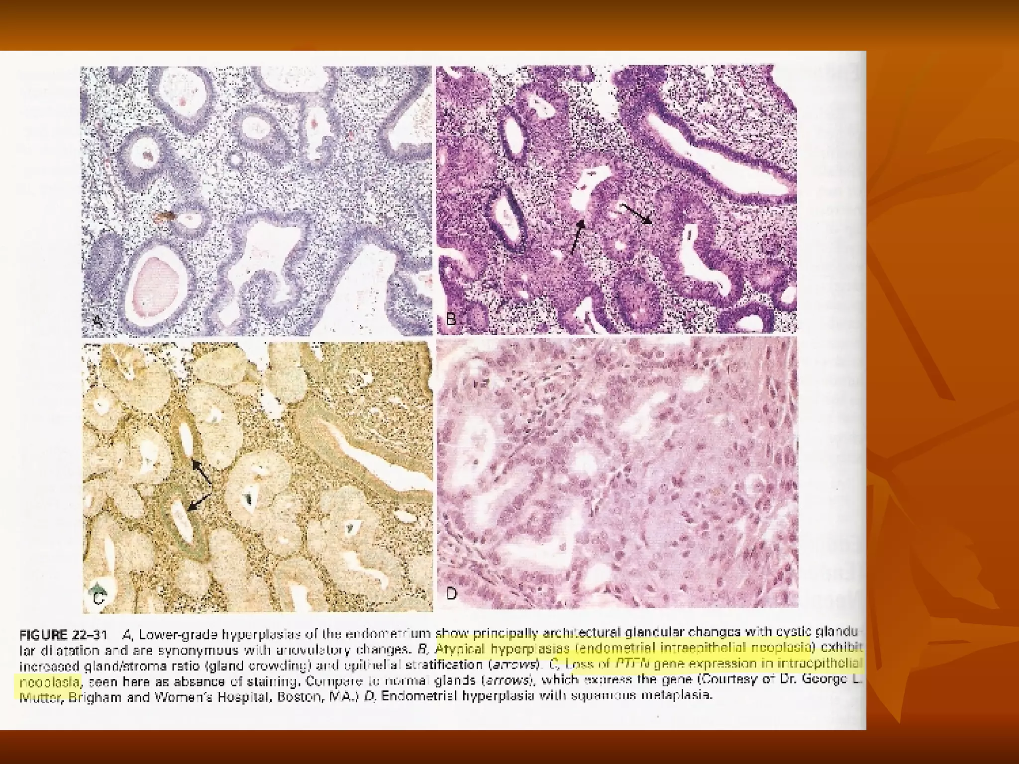 Female Genital Tract Pathology | PPT