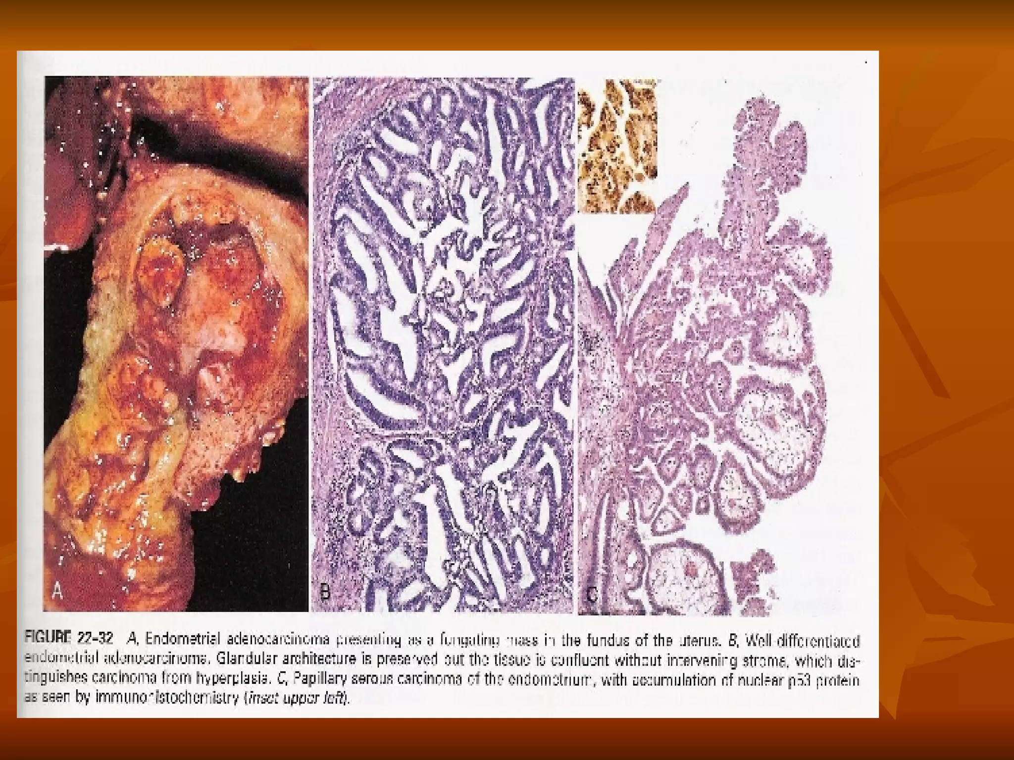 Female Genital Tract Pathology | PPT