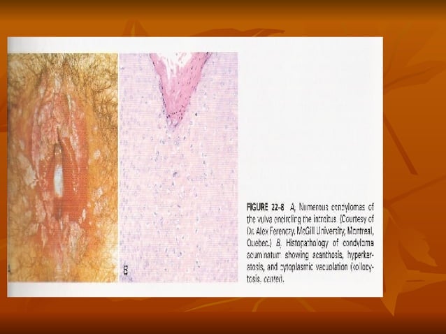 Female Genital Tract Pathology | PPT | Reproductive Health | Diseases ...