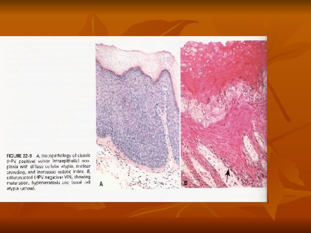 Female Genital Tract Pathology | PPT | Reproductive Health | Diseases ...