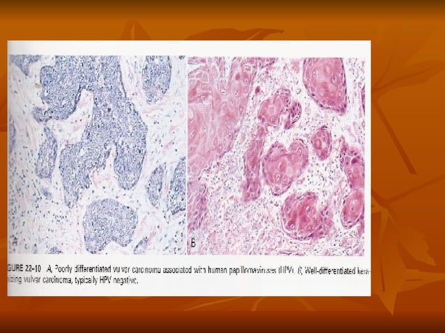 Female Genital Tract Pathology | PPT | Reproductive Health | Diseases ...