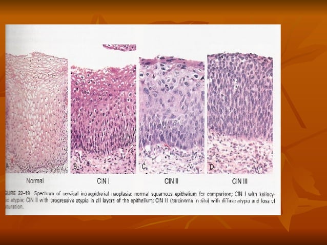 Female Genital Tract Pathology | PPT | Reproductive Health | Diseases ...