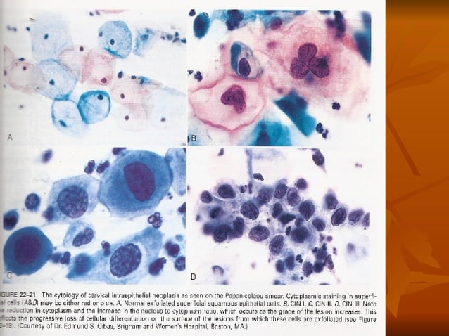 Female Genital Tract Pathology | PPT | Reproductive Health | Diseases ...