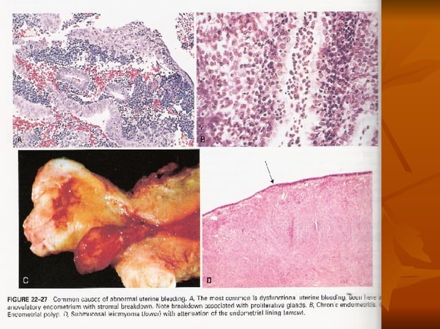 Female Genital Tract Pathology | PPT | Reproductive Health | Diseases ...