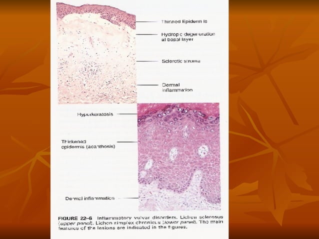 Female Genital Tract Pathology | PPT | Reproductive Health | Diseases ...