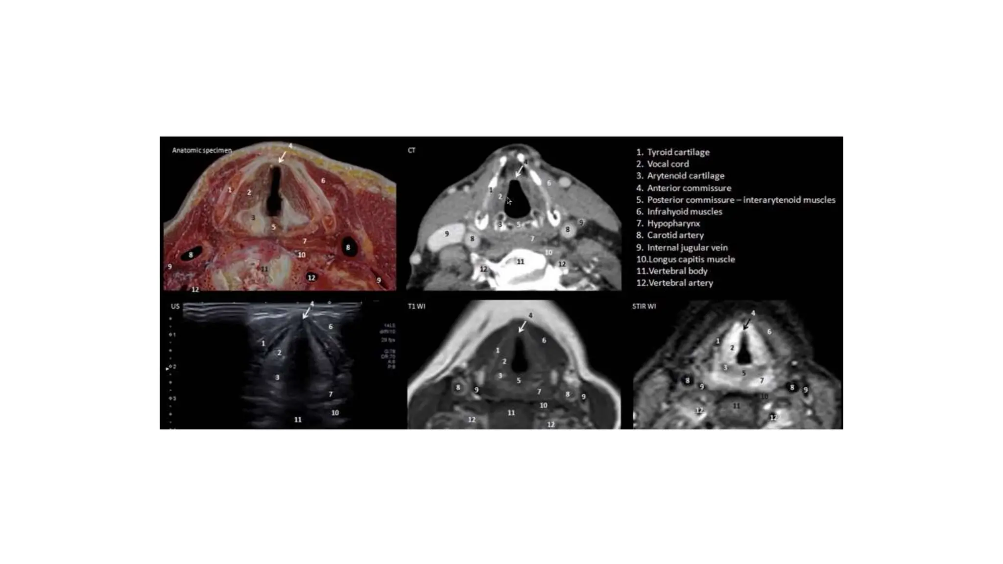 Review Laring Anatomi - Anatomy of Larynx.pptx