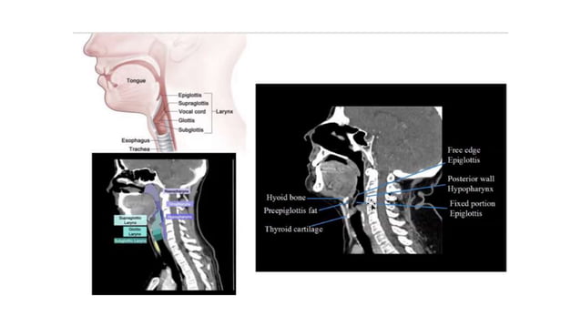Review Laring Anatomi - Anatomy of Larynx.pptx