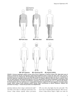 Levodopa-Induced Dyskinesia in Parkinson Disease: Current and Evolving ...