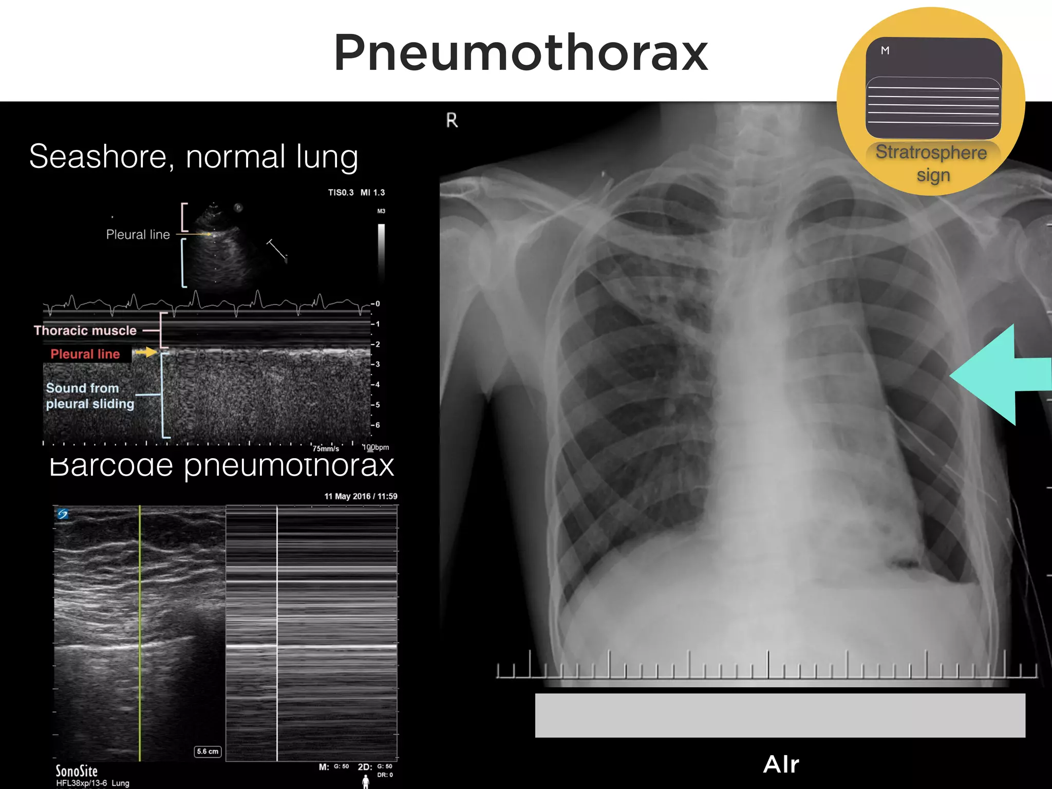 Review lung ultrasound | PDF
