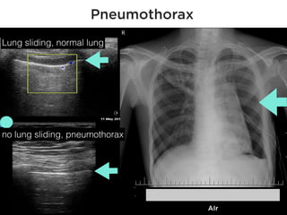 Review lung ultrasound | PDF