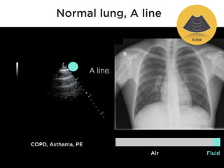 Review lung ultrasound | PDF