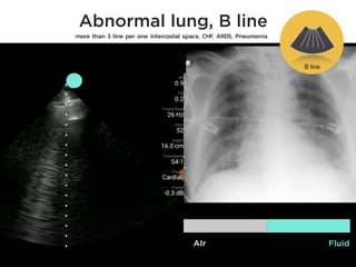 Review lung ultrasound | PPT
