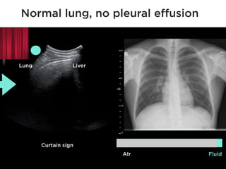 Review lung ultrasound | PPT