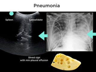Review lung ultrasound | PPT