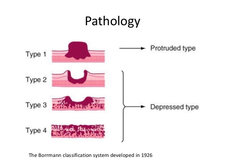 Review of management of gastric cancer