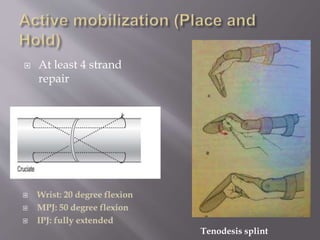 Review of rehabilitation protocol after Flexor tendon injuries | PPT