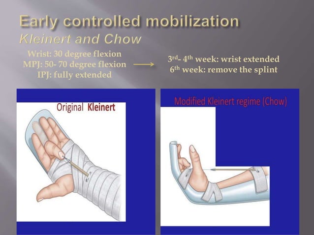 Review of rehabilitation protocol after Flexor tendon injuries