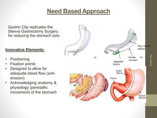 Gastric clip | PPTX
