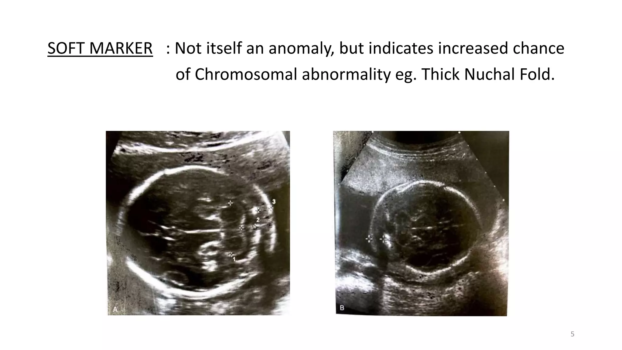 18 - 22 Weeks Anomaly Scan | PPTX