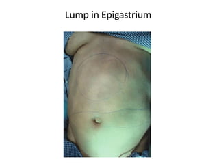 Abdominal lump it's evaluation and management.pptx