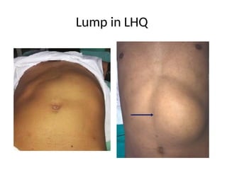 Abdominal lump it's evaluation and management.pptx