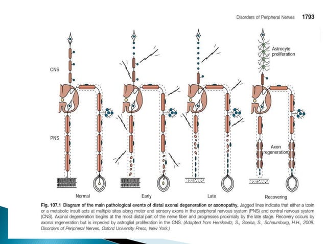 Approach to PERIPHERAL NEUROPATHY | PPTX