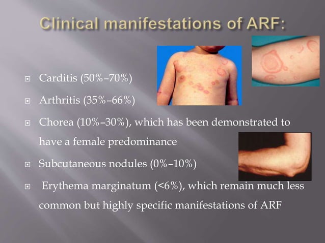 Revised jones criteria | PPTX