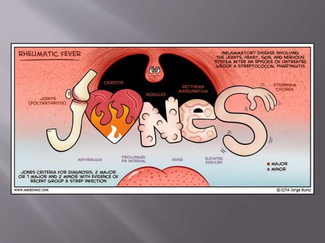 Revised jones criteria | PPTX