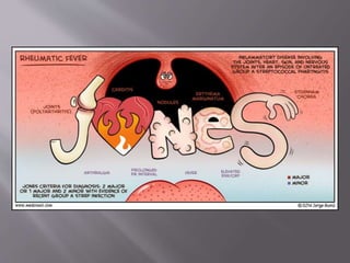 Revised jones criteria | PPT
