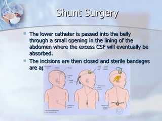 Hydrocephalus and Shunts: Sean's Story | PPT