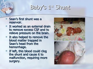 Hydrocephalus and Shunts: Sean's Story | PPT