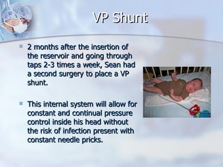 Hydrocephalus and Shunts: Sean's Story | PPT