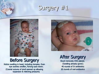 Hydrocephalus and Shunts: Sean's Story | PPT