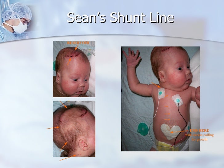 Hydrocephalus and Shunts: Sean's Story
