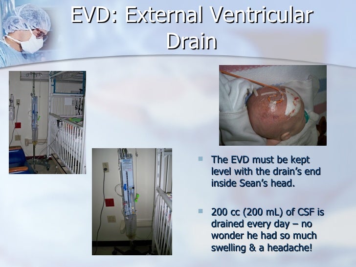 Scars Shunt Hydrocephalus Hydrocephalus And Shunts: Sean's Story