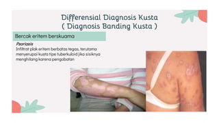 REVISI 2 DIAGNOSIS DAN KLASIFIKASI KUSTA | PPT