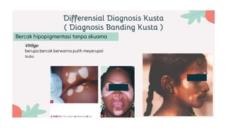 REVISI 2 DIAGNOSIS DAN KLASIFIKASI KUSTA | PPT