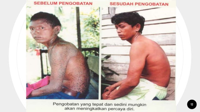 REVISI 2 PENGOBATAN KUSTA | PPTX
