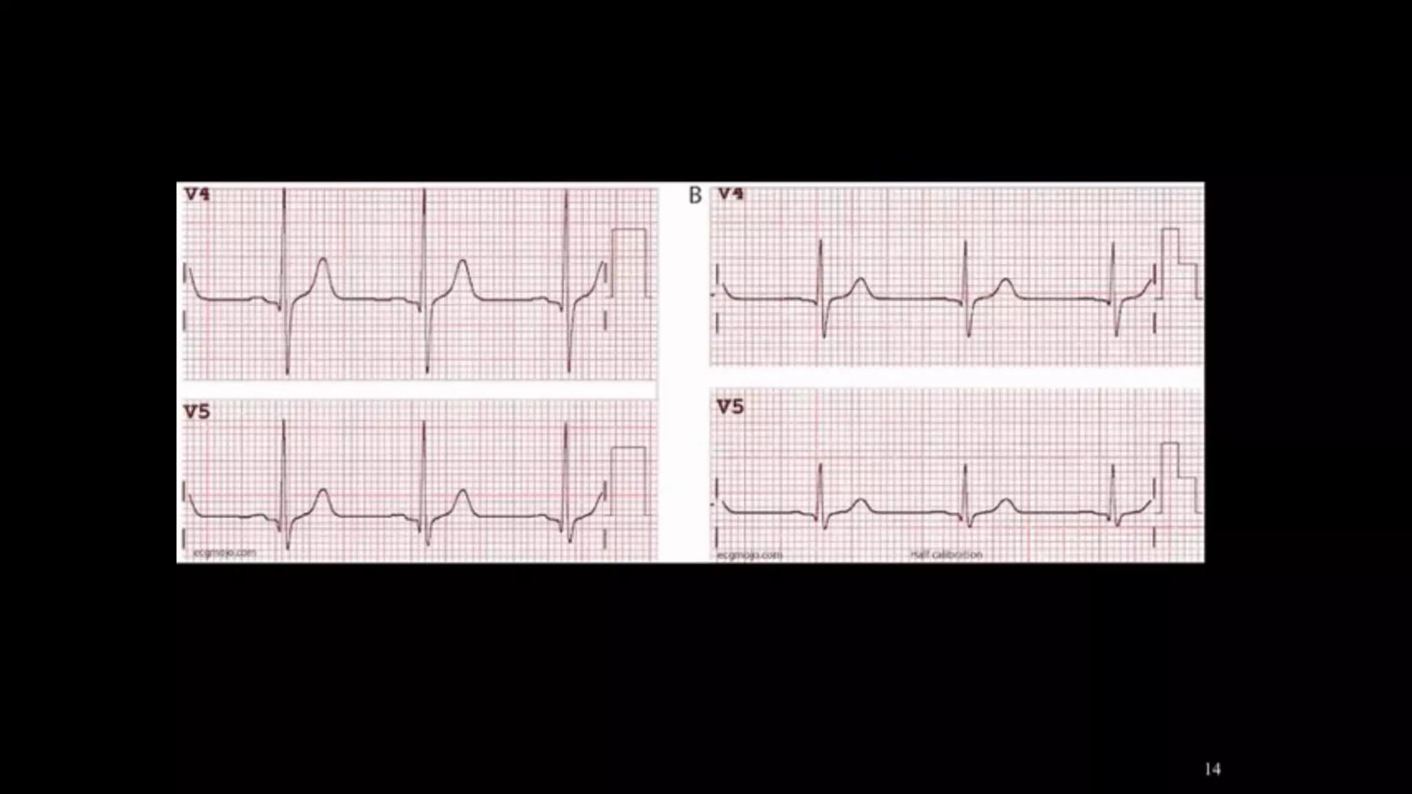 REVISI Materi 1 ECG Club - Dasar EKG, Sinus, Rate.pptx