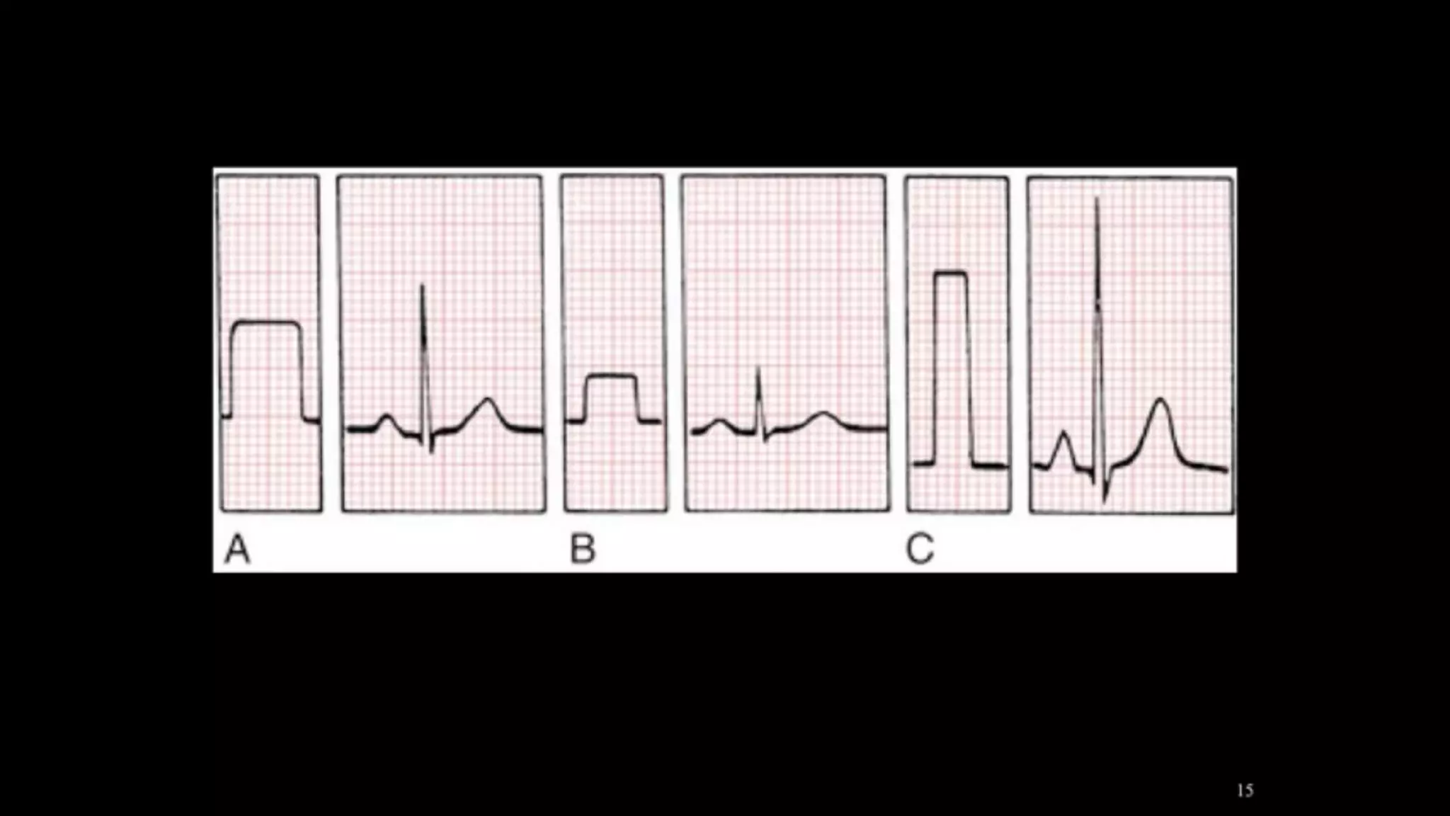 REVISI Materi 1 ECG Club - Dasar EKG, Sinus, Rate.pptx