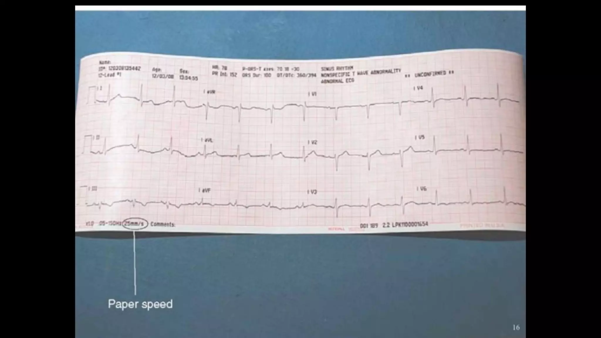 REVISI Materi 1 ECG Club - Dasar EKG, Sinus, Rate.pptx